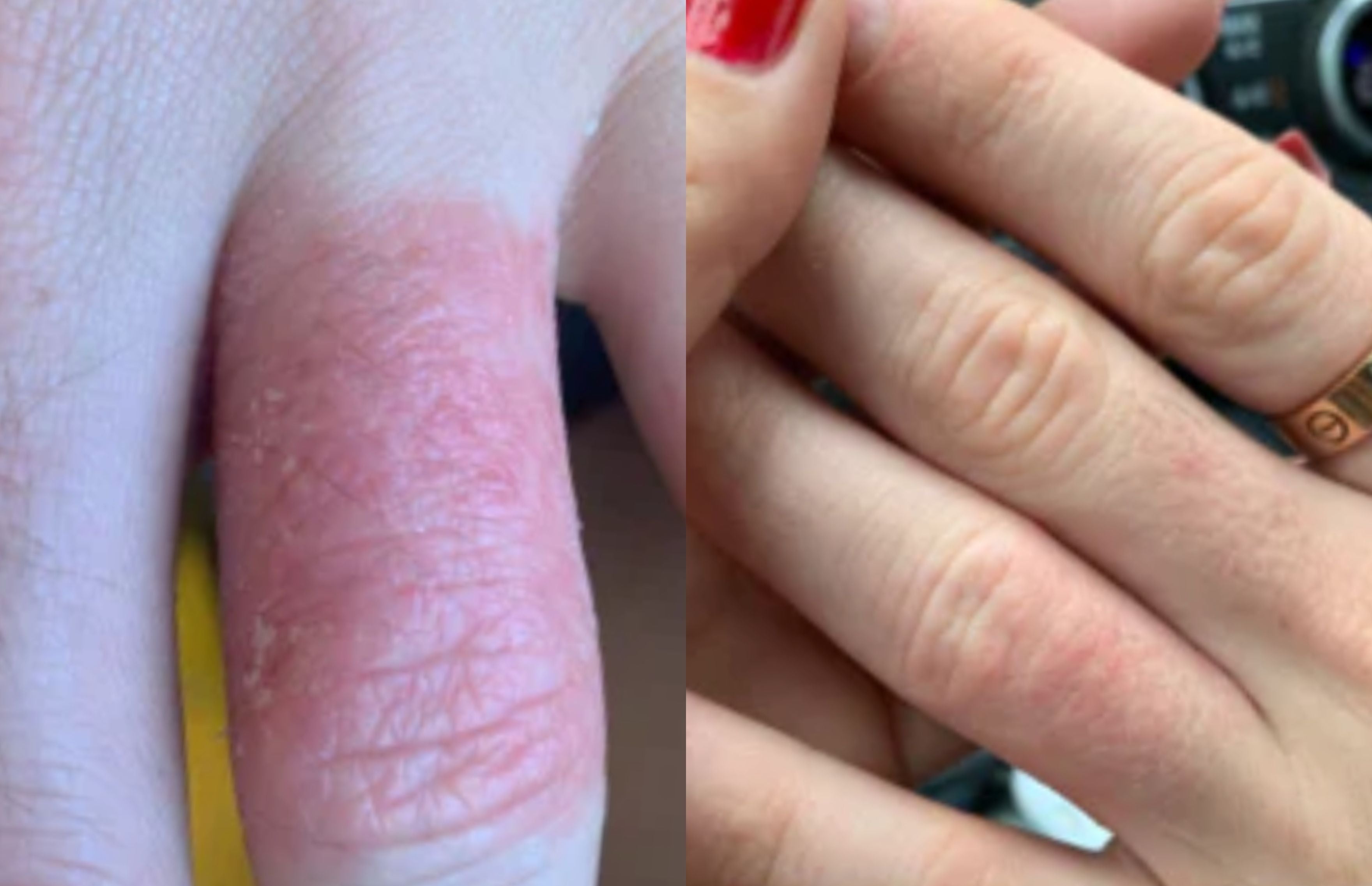 How ed&i has helped with eczema and sensitive skin – ednibody